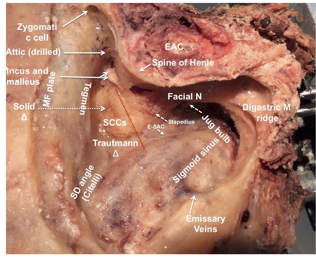 Temporal Bone Anatomy (Cadaveric Dissection) | Iowa Head and Neck Protocols - Carver College of ...